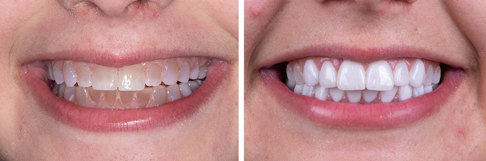 Tudo o que precisa de saber sobre Facetas Dentárias