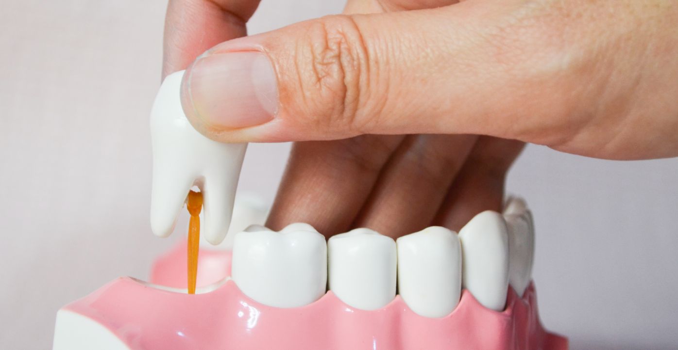Extrair o dente do siso: Sintomas, Cirurgia e Recuperação