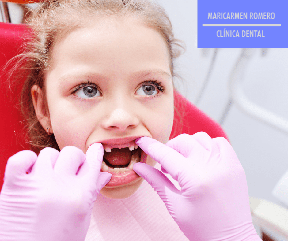 ¿Cómo detectar caries en niños?